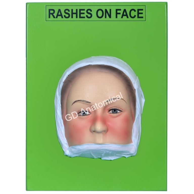 Rashes On Face Model – GD Anatomicals